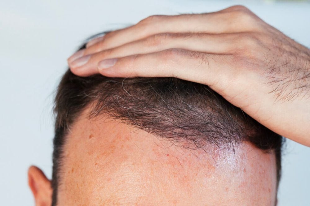 Hair Transplant Surgery Review with Dr Scott Alexander